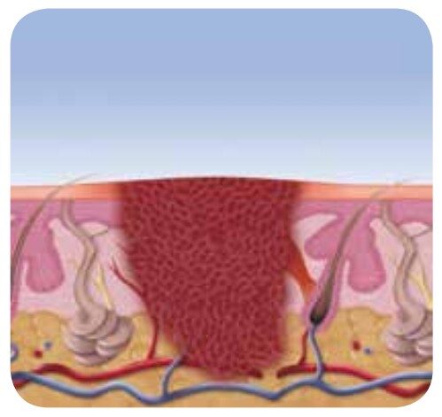 Verruca Treatment Before & After | Clear Step NZ